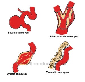 Health and Medical ArticlesMycotic Aneurysm - Health and Medical Articles