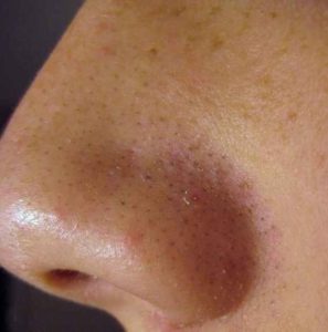 Infected Blackheads - Pictures, Symptoms, Causes, Treatment