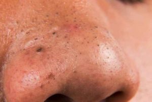 Infected Blackheads - Pictures, Symptoms, Causes, Treatment