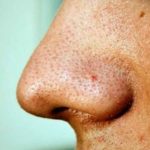Infected Blackheads - Pictures, Symptoms, Causes, Treatment