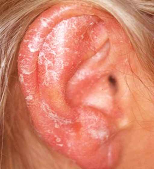 Dry Skin In Ears Pictures What Causes It And How To Treat Dry Skin In Ears Pictures What Causes It And How To Treat