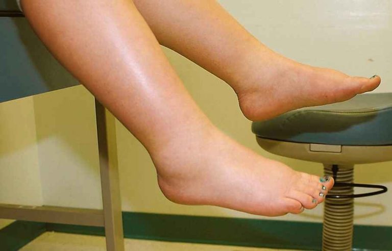 Health and Medical ArticlesWeeping Edema - Health and Medical Articles