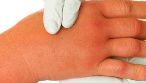 Weeping Edema - Types, Causes, Treatment, Pictures, Remedies