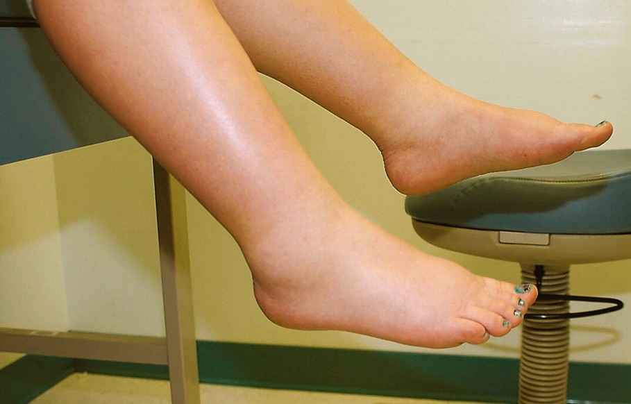 Weeping Edema Types Causes Treatment Pictures Remedies Weeping Edema Types Causes Treatment Pictures Remedies