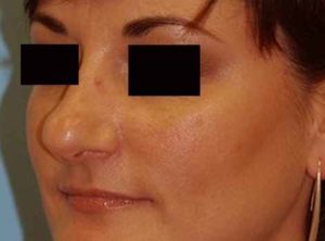 Health and Medical ArticlesBulbous Nose - Health and Medical Articles