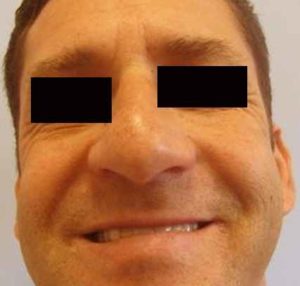 Health and Medical ArticlesBulbous Nose - Health and Medical Articles