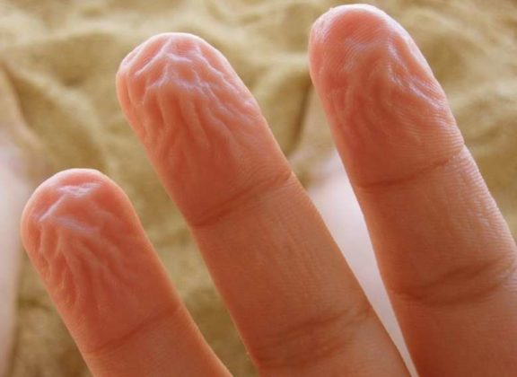 Health and Medical ArticlesWrinkled Fingertips - Health and Medical ...