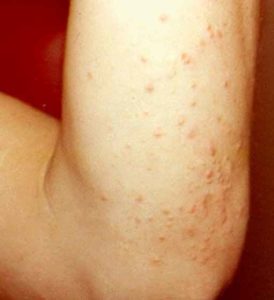 Itchy Bumps on Arms - Pictures, Symptoms, Causes, Treatment