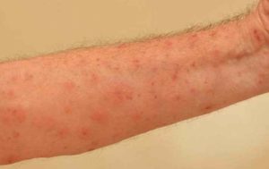 Itchy Bumps on Arms - Pictures, Symptoms, Causes, Treatment