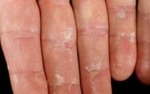 Peeling Fingertips - Pictures, Causes and Treatment