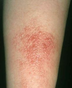 Health and Medical ArticlesPoison Ivy Rash - Health and Medical Articles