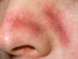 What is Red Blotchy Skin? Pictures, Causes and How to Treat