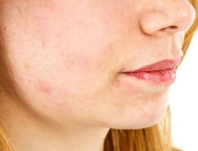 Swollen Cheek Symptoms Causes Treatment Pictures Swollen Cheek Symptoms Causes Treatment Pictures